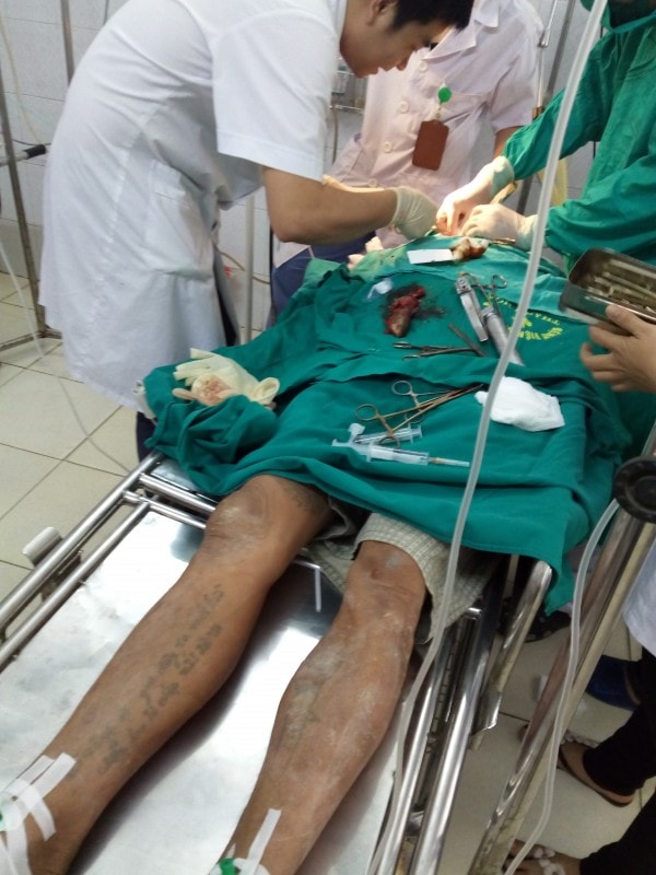 Thanh Hóa: Một người dân bị cá rô chui vào phế quản